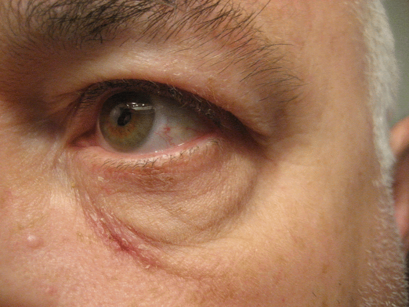 Brucine Scaly Skin Under Eye brucine-scaly-skin-under-eye