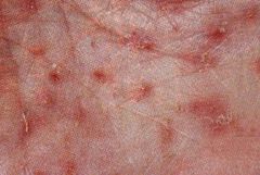 Scabies Rash | What's The Symptoms of