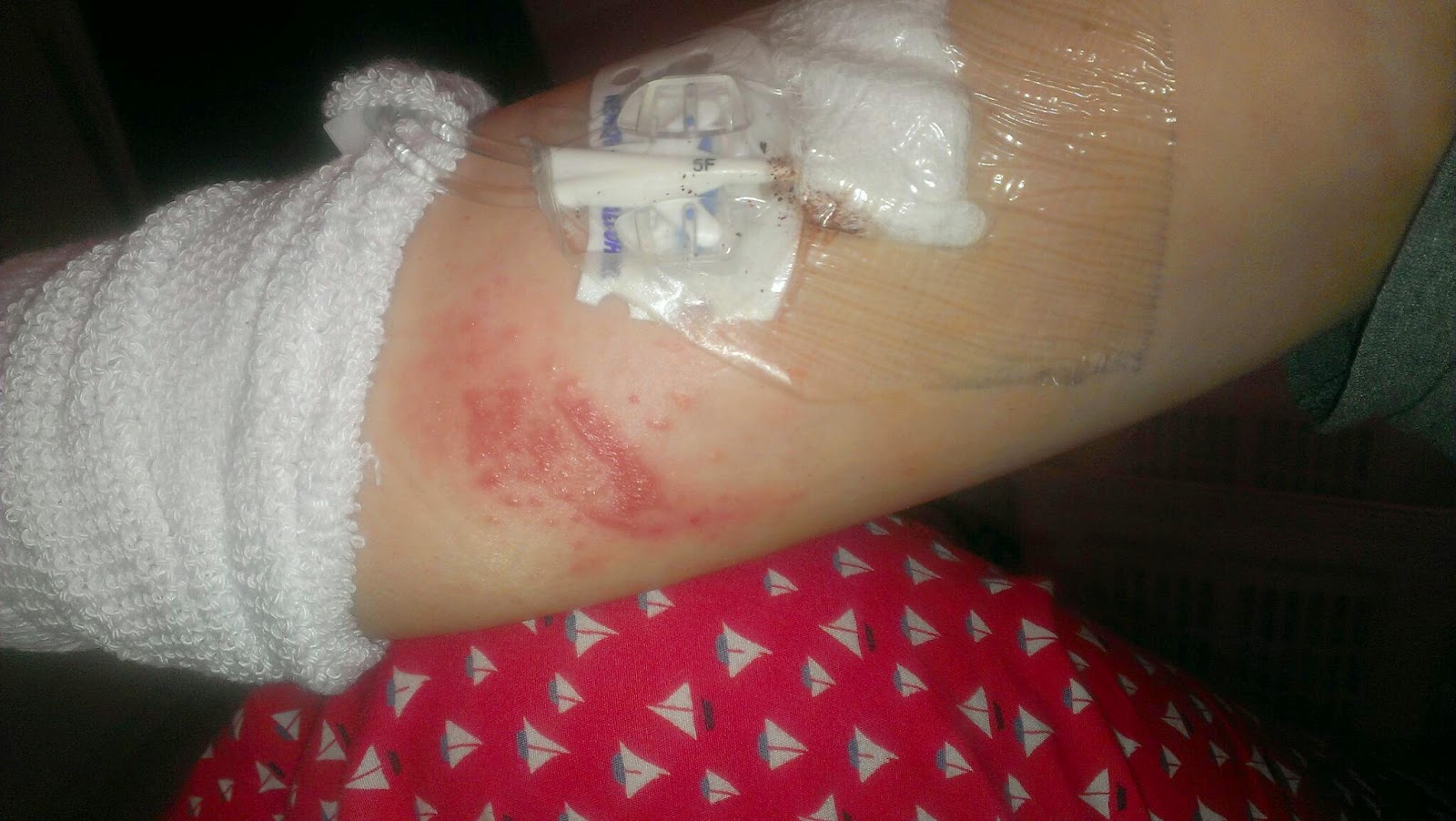 Melissa's Lyme Life: PICC line problems