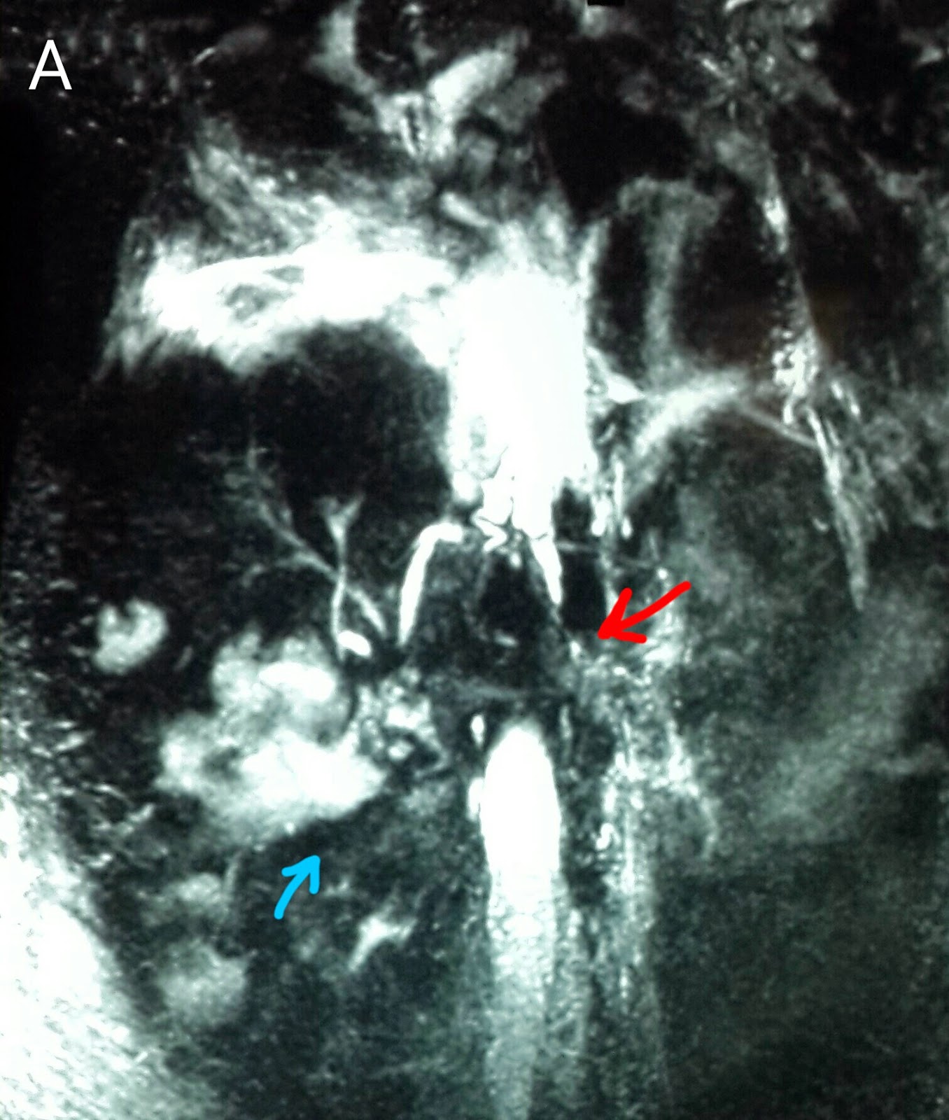 ERCP & EGD : Major biliary tree disruption post surgery