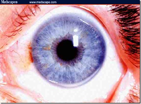 MedSemio: Dislipidemia – Arco corneal