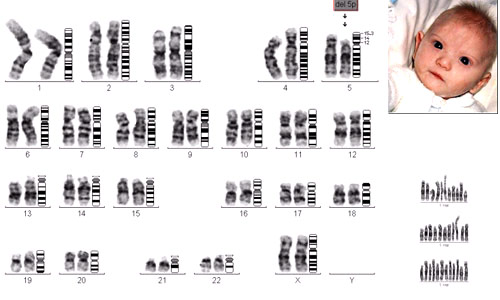 The medical world: Cri-du-chat Syndrome