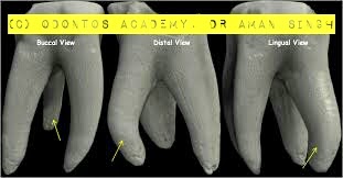 ODONTOS ACADEMY FOR CLINICAL DENTAL STUDIES: Radix Entomolaris and ...