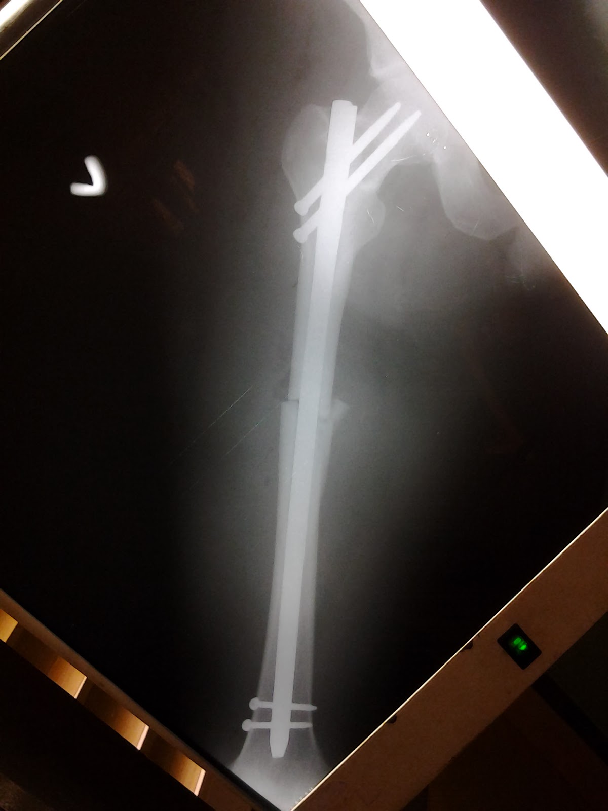 Dr Syukran: Closed proximal 3rd left femur fracture