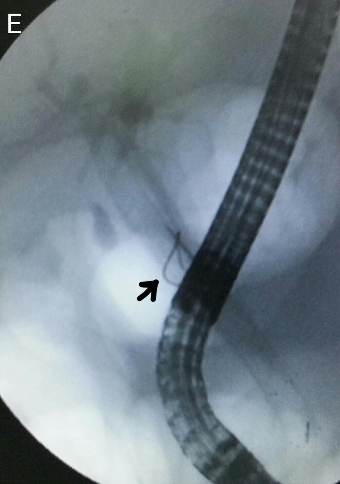 ERCP & EGD : A blocked stent within a blocked stent