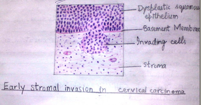 Histology Slides Database: Stromal invasion in cervical carcinoma