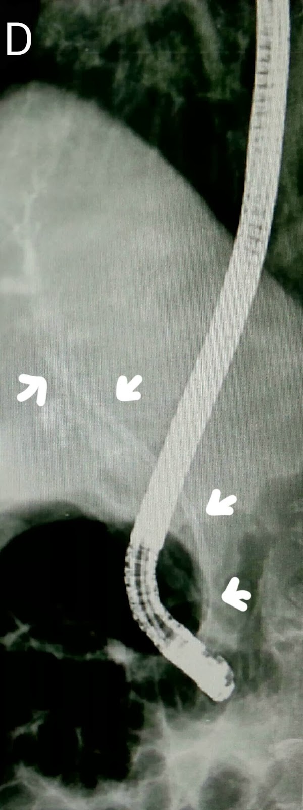 ERCP & EGD : An extraordinarily large duodenal diverticulum