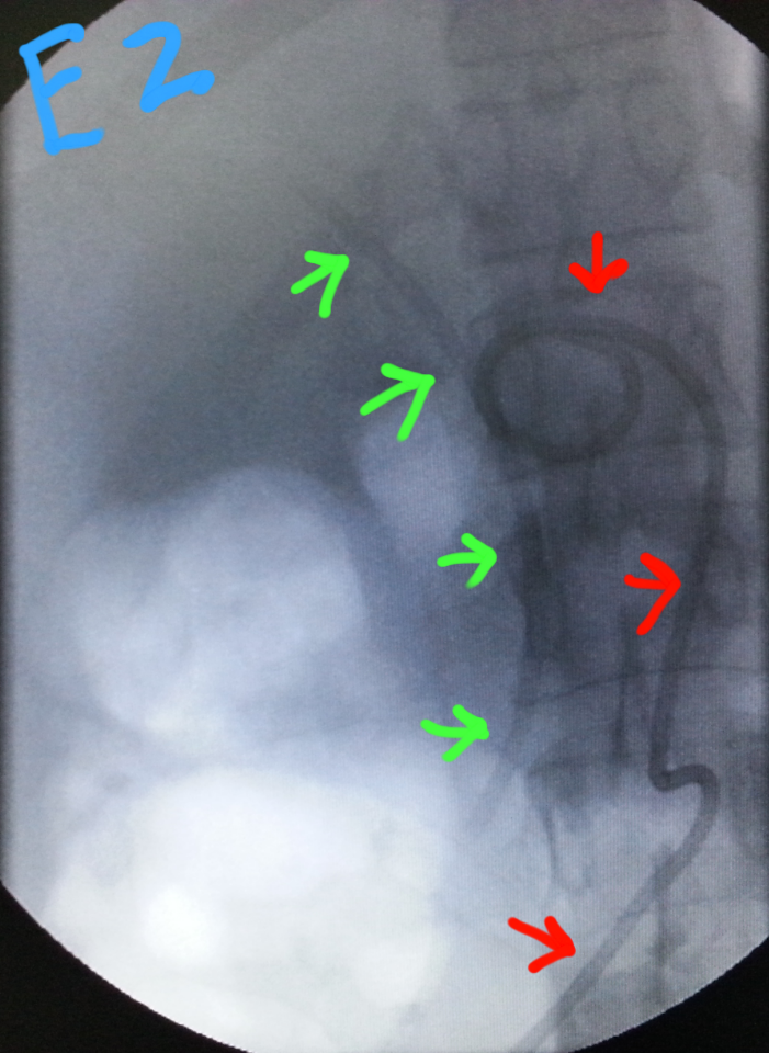 ERCP & EGD : Iatrogenic CBD injury with bile leakage during cholecystectomy