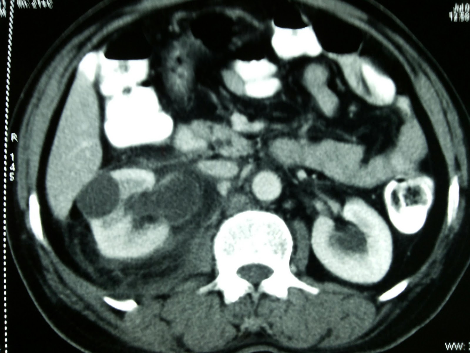 RADIOLOGY IMAGE SPOTTERS: Urinoma ct kub