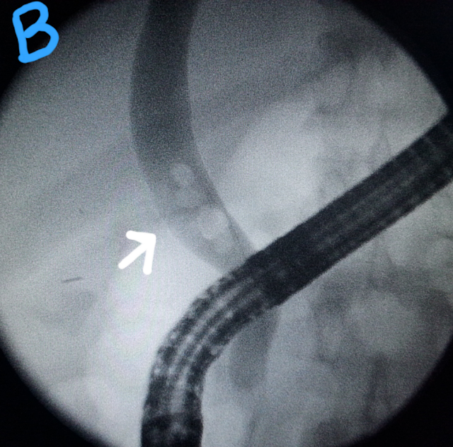 ERCP & EGD : Managing choledocholithiasis and a damaged pancreatic duct ...