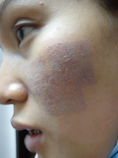 love plethora: Vera post fractional laser
