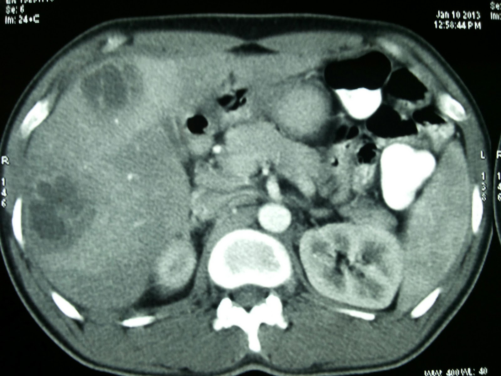 RADIOLOGY IMAGE SPOTTERS: Pyogenic liver abscess