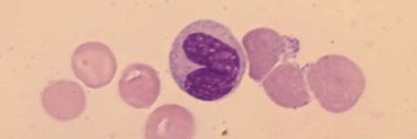 Como identificar metamielócitos na distensão sanguínea | Biomedicina Padrão