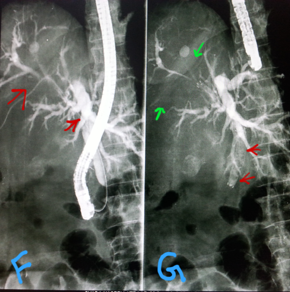 ERCP & EGD : Adenocarcinoma of gallbladder infiltrating into common ...