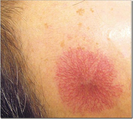 Medical Megamania: Spider naevi