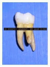 ODONTOS ACADEMY FOR CLINICAL DENTAL STUDIES: Radix Entomolaris and ...