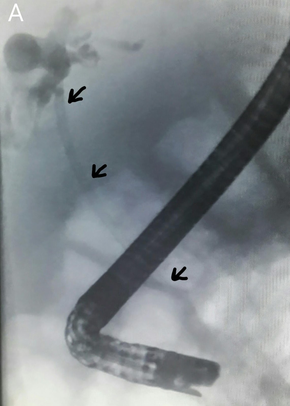 ERCP & EGD : Migrated biliary stent