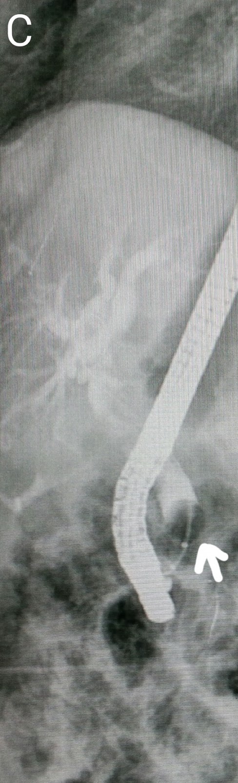 ERCP & EGD : Retained CBD stones post cholecystectomy