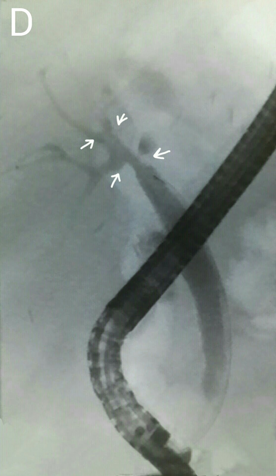 ERCP & EGD : Third follow up ERCP for post transplant anastomotic ...