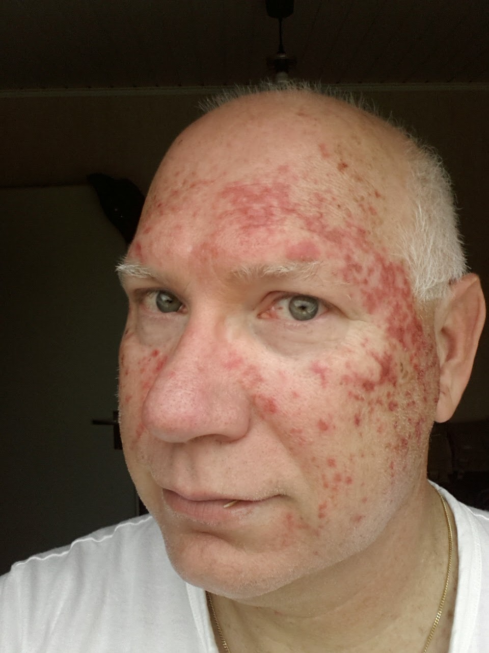 Resultaat gebruik Efudix: Dag 10