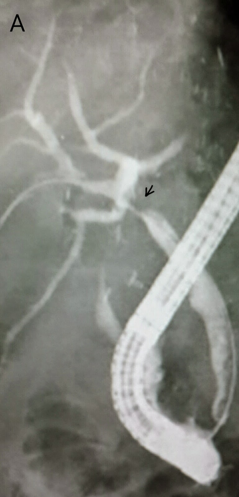 ERCP & EGD : Fourth follow-up ERCP for post lover transplant ...