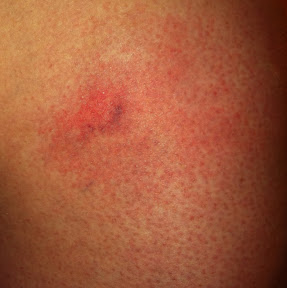 Attack of the Fiddleback!: Week One of my Brown Recluse Spider Bite ...