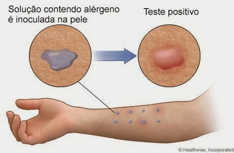 Hipersensibilidade Tipo I – Imediata ou Anafilática | Biomedicina Padrão