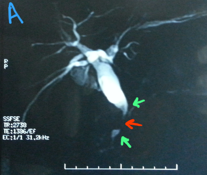 ERCP & EGD : Distal CBD stricture