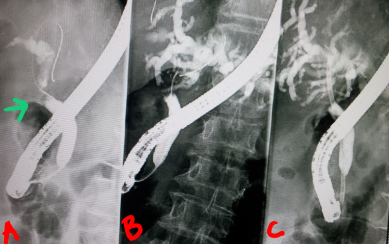 ERCP & EGD : Malignant biliary stricture secondary to infiltration by ...