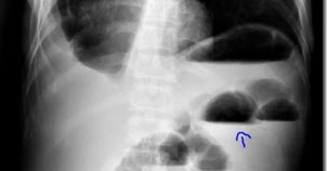 X-Ray findings in In Intestinal Obstruction and Perforation-X-Ray Erect ...