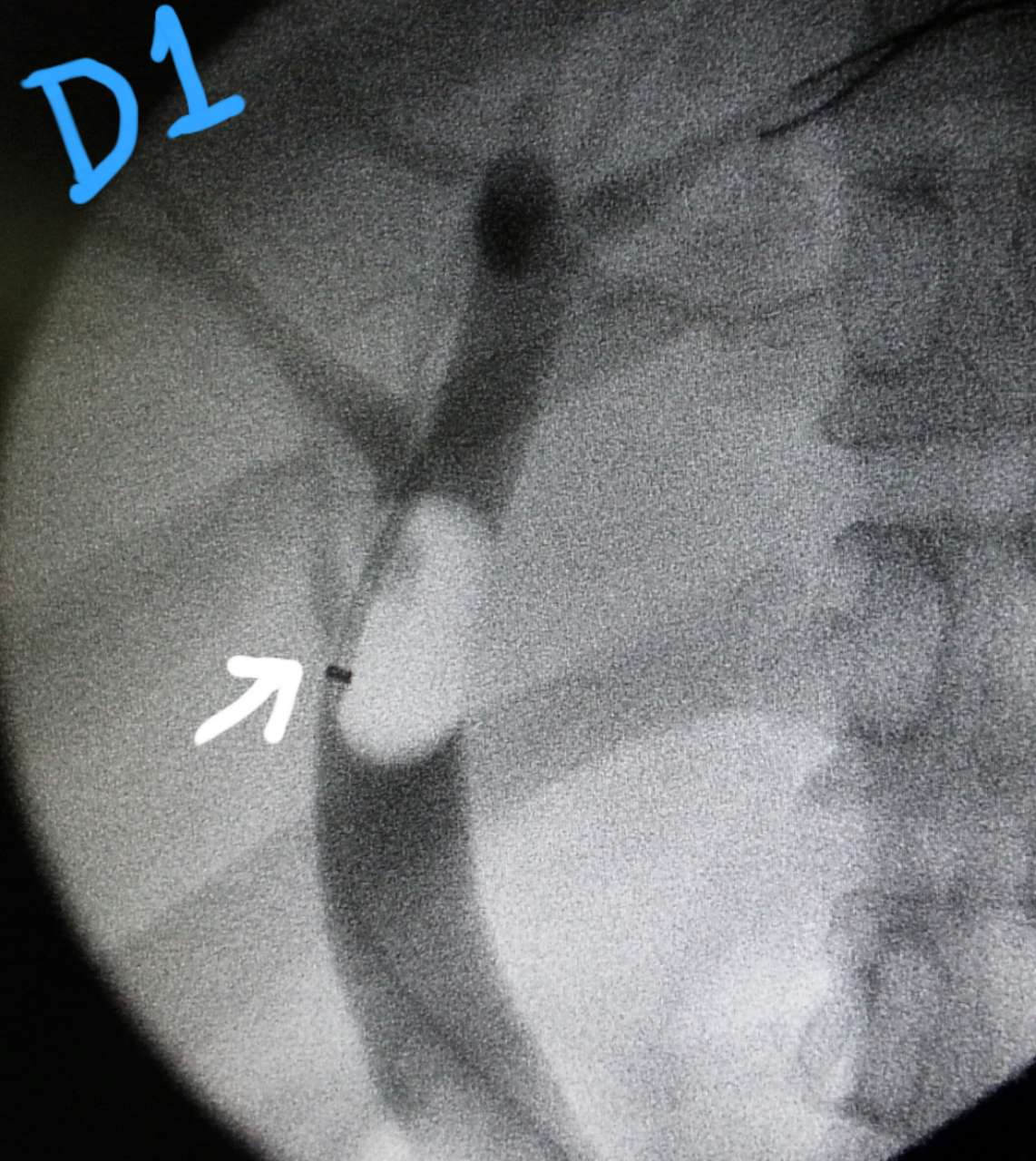 ERCP & EGD : Managing choledocholithiasis and a damaged pancreatic duct ...