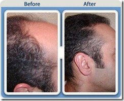 Hair Transplant in Pakistan: A Comparison between Strip Harvesting and ...