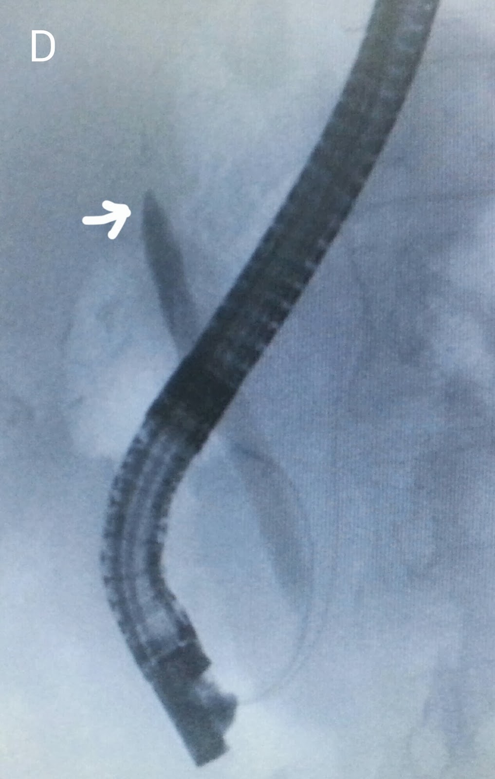 ERCP & EGD : Post transplant anastomotic biliary stricture occurring 7 ...