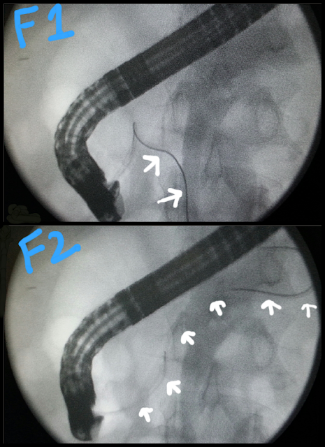ERCP & EGD : Managing choledocholithiasis and a damaged pancreatic duct ...