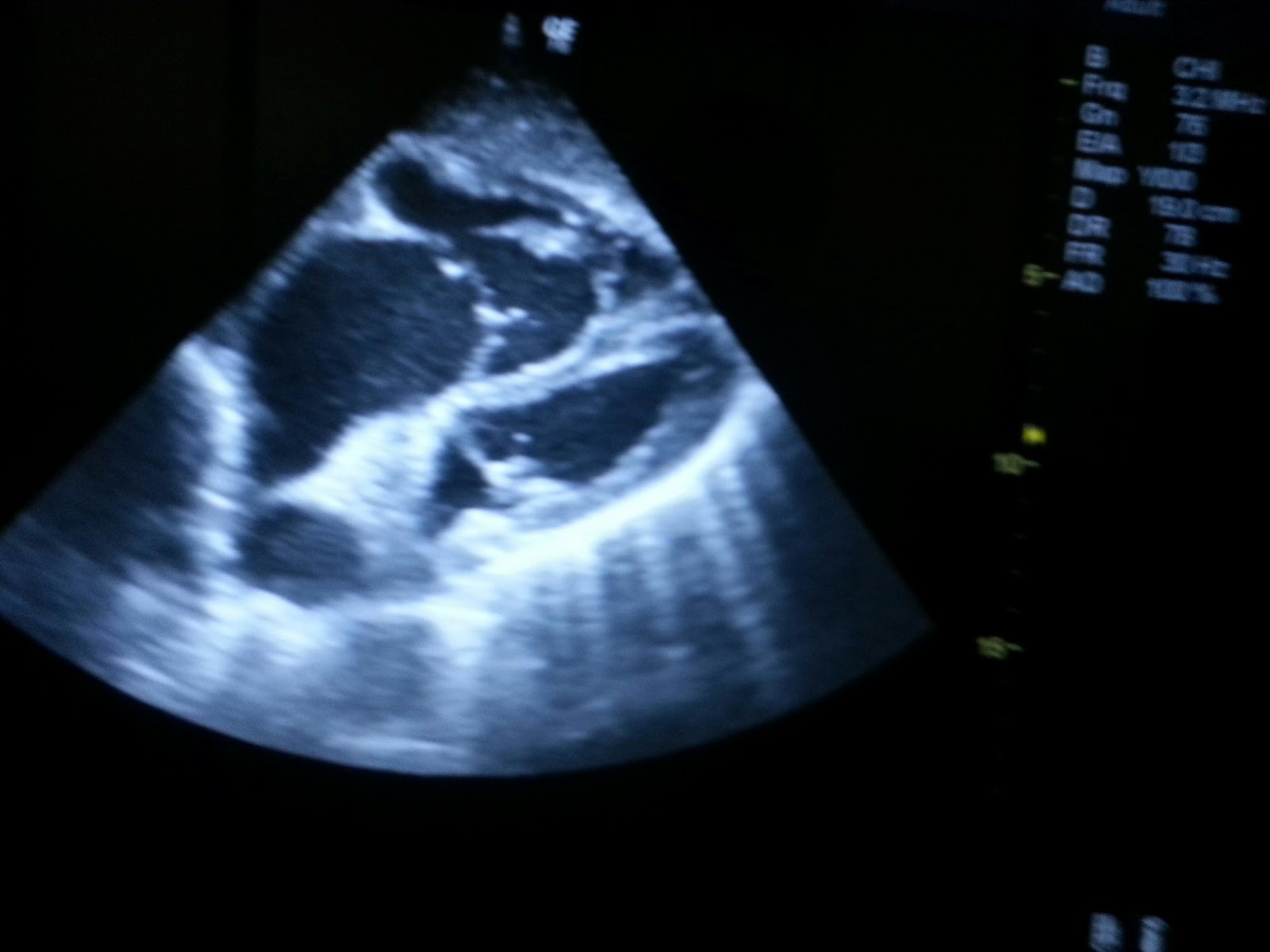 NEELZ ON WHEELZ: COR PULMONALE .dilated RA RV, pulmonary regurgitation ...