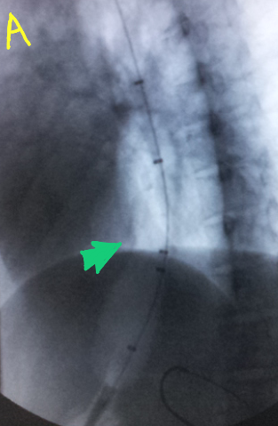 ERCP & EGD : Balloon dilatation for achalasia of cardia