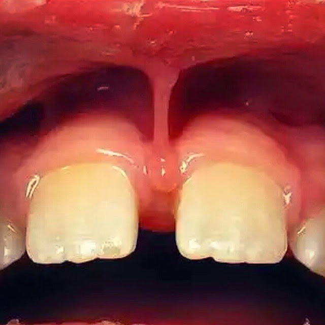Dra. Renata Licciardi - Endodontia Especializada e Clínica Geral: Freio ...