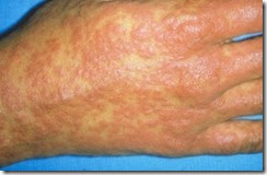 PENICILLIN ALLERGEY ~ Revolution PharmD